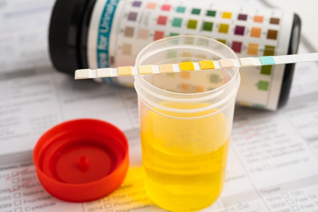 Urine Routine & Microscopic Examination at Home: Your Comprehensive ...