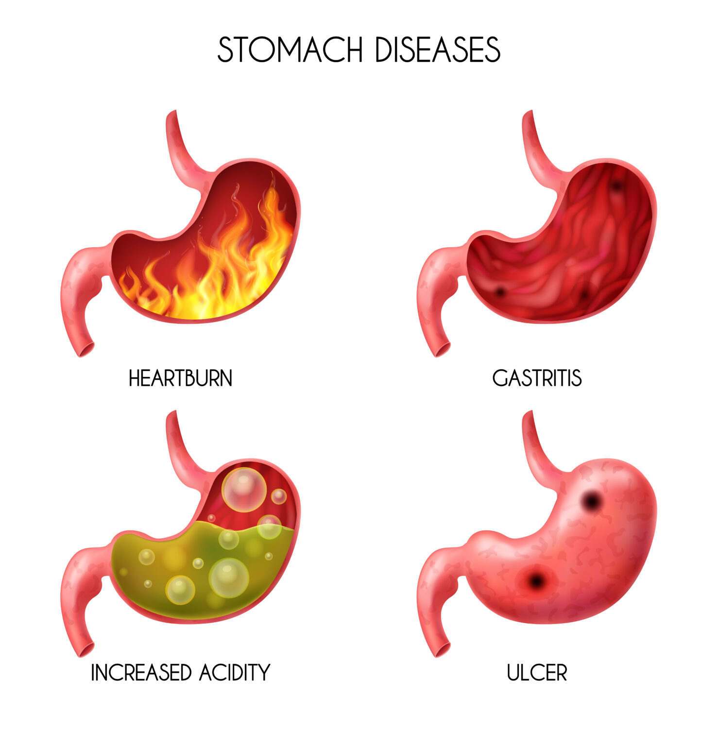 Stomach Diseases: Causes, Symptoms, Prevention, and Treatment - Health ...